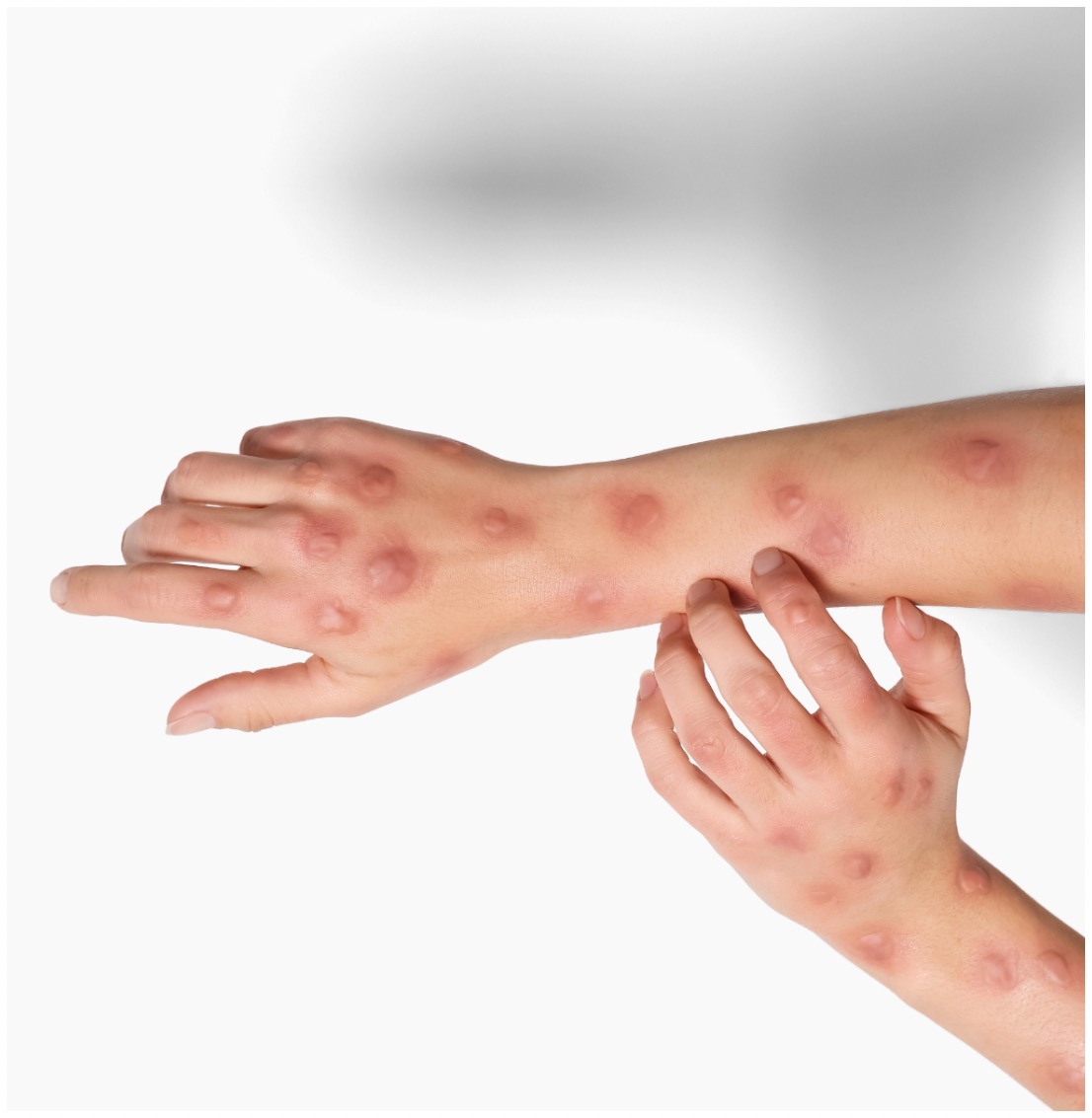Monkeypox: Davao City’s First Case of Mpox - VisMin.ph